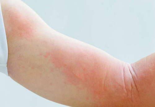 Anxiety Rash Pictures | Medical Pictures and Images - (2023 Updated)
