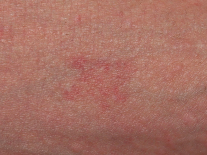 Atopisch eczeem behandelen met haakwormen: Inoculatie gelukt!