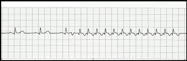 Practice EKG Rhythm Strips 134
