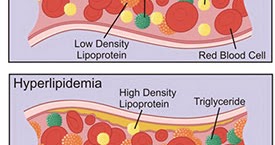 Hiperlipidemia ~ Informasi Kedokteran Dan Kesehatan