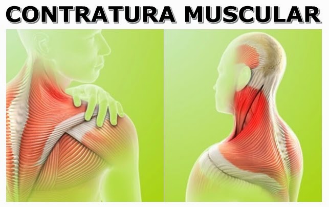 Contratura Muscular