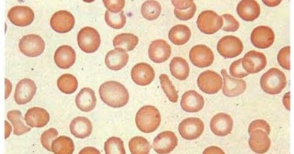 FICHERO HEMATOLOGIA : Anisocitosis