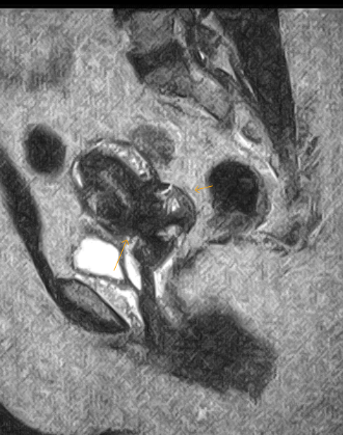 Adenomyosis-MRI - Sumer's Radiology Blog