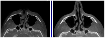 Facial Development Newsletter: AN ALTERNATIVE TREATMENT TO LEFORTE ...