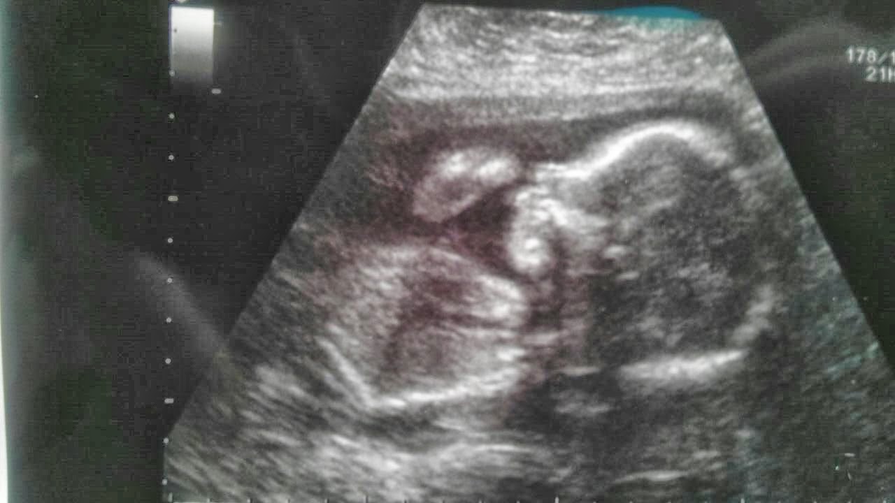 Baby Black's Blog: Anatomy Scan for Baby #3