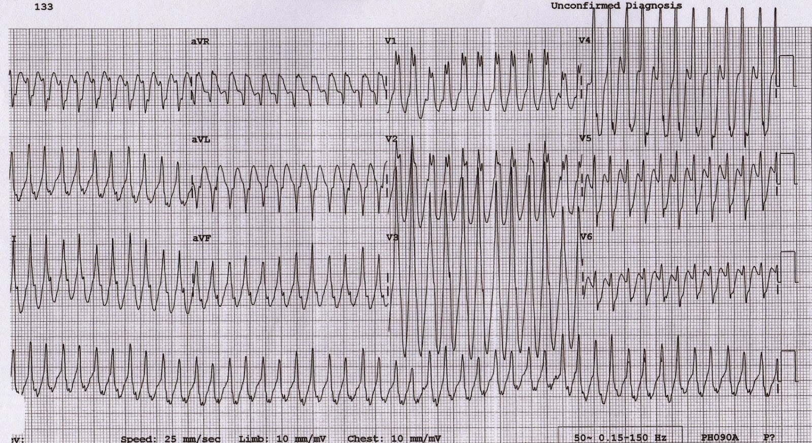 Atrioventricular Reentry Tachycardia | INA - ECG