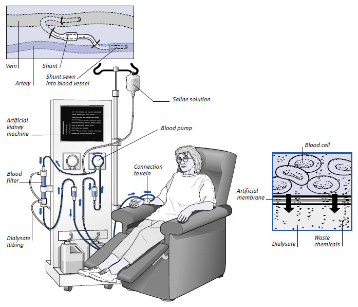Procedure for dialysis ~ Nursing