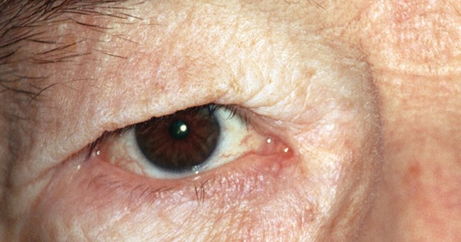 Blepharochalasis - Pictures, Meaning, Symptoms, Causes, Treatment ...