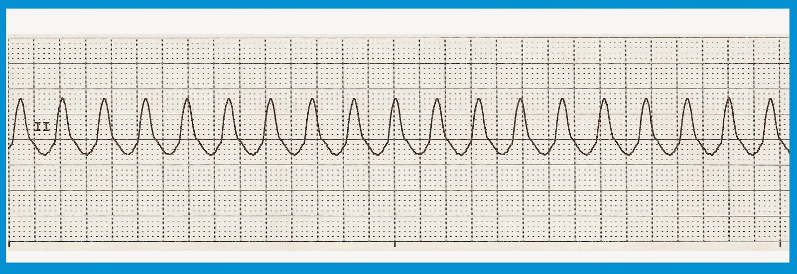 Images Of Ventricular Tachycardia