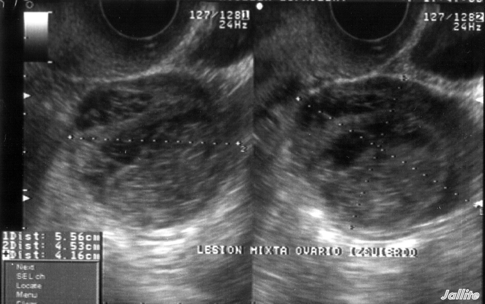 Quiste Ovarico Complejo