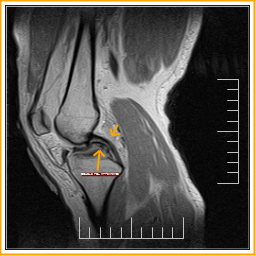O'Donoghue's unhappy triad -MRI - Sumer's Radiology Blog