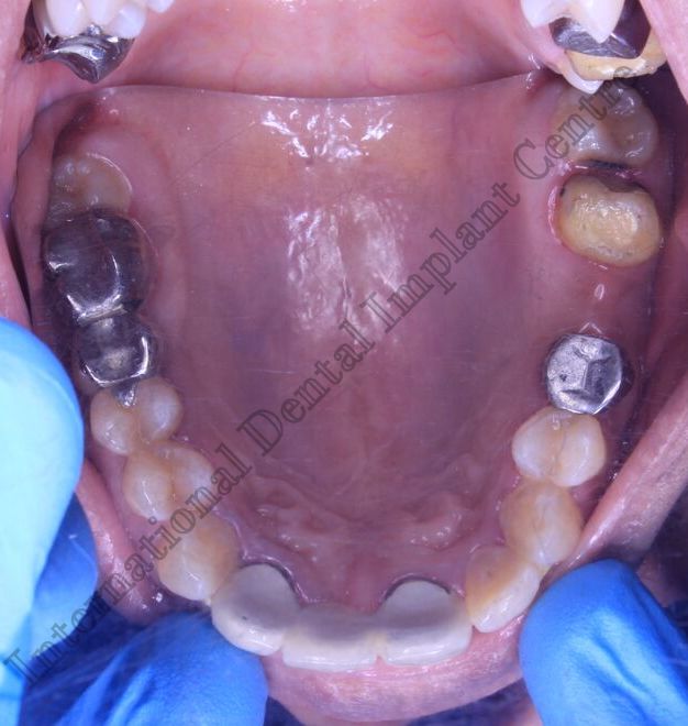 Clinical certification course on Basal implantology in INDIA: Basal ...