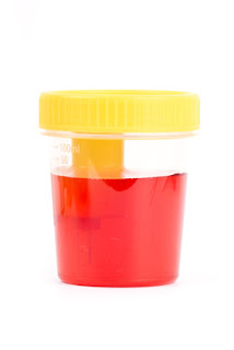 Orina Roja ¿Hematuria? ~ El Médico Contesta