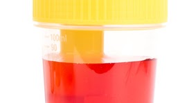 Orina Roja ¿Hematuria? ~ El Médico Contesta