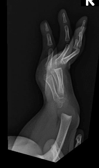 Radial Deficiency- Every Child is Unique | Congenital Hand and Arm ...