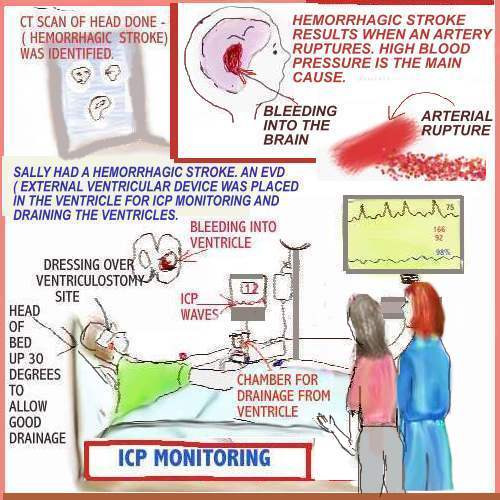 Dear Nurses: WHY IS ICP MONITORING DONE?