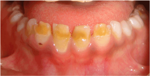 Molar Incisor Hypomineralization ~ Dentistry and Medicine