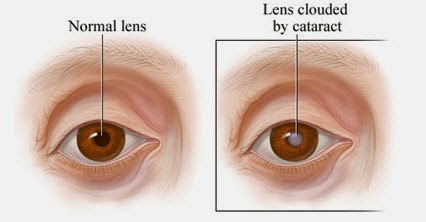 LAPORAN PENDAHULUAN GANGGUAN PENGLIHATAN