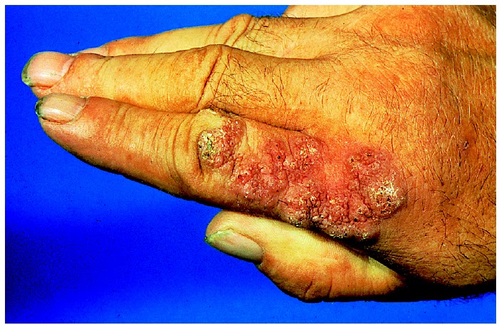 Blog del Internista: Resumenes de Dermatología - Enfermedades ...