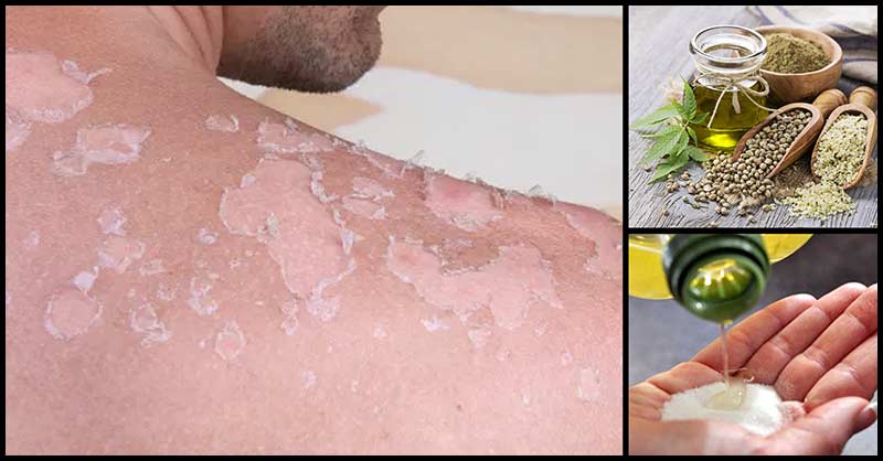 4 Natural Remedies That Can Help People With Skin Cancer | Dr Farrah MD