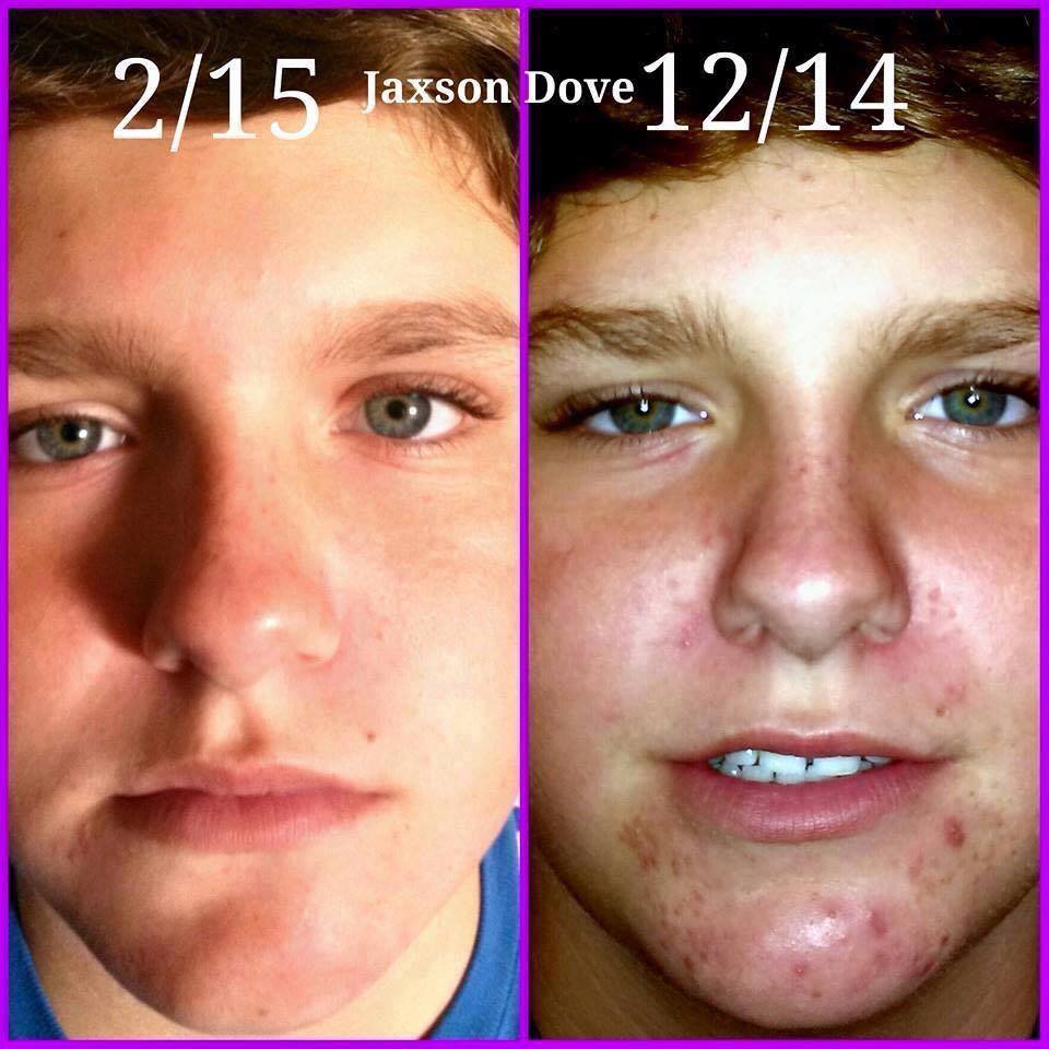 Forehead Acne: 9 Year Old With Acne