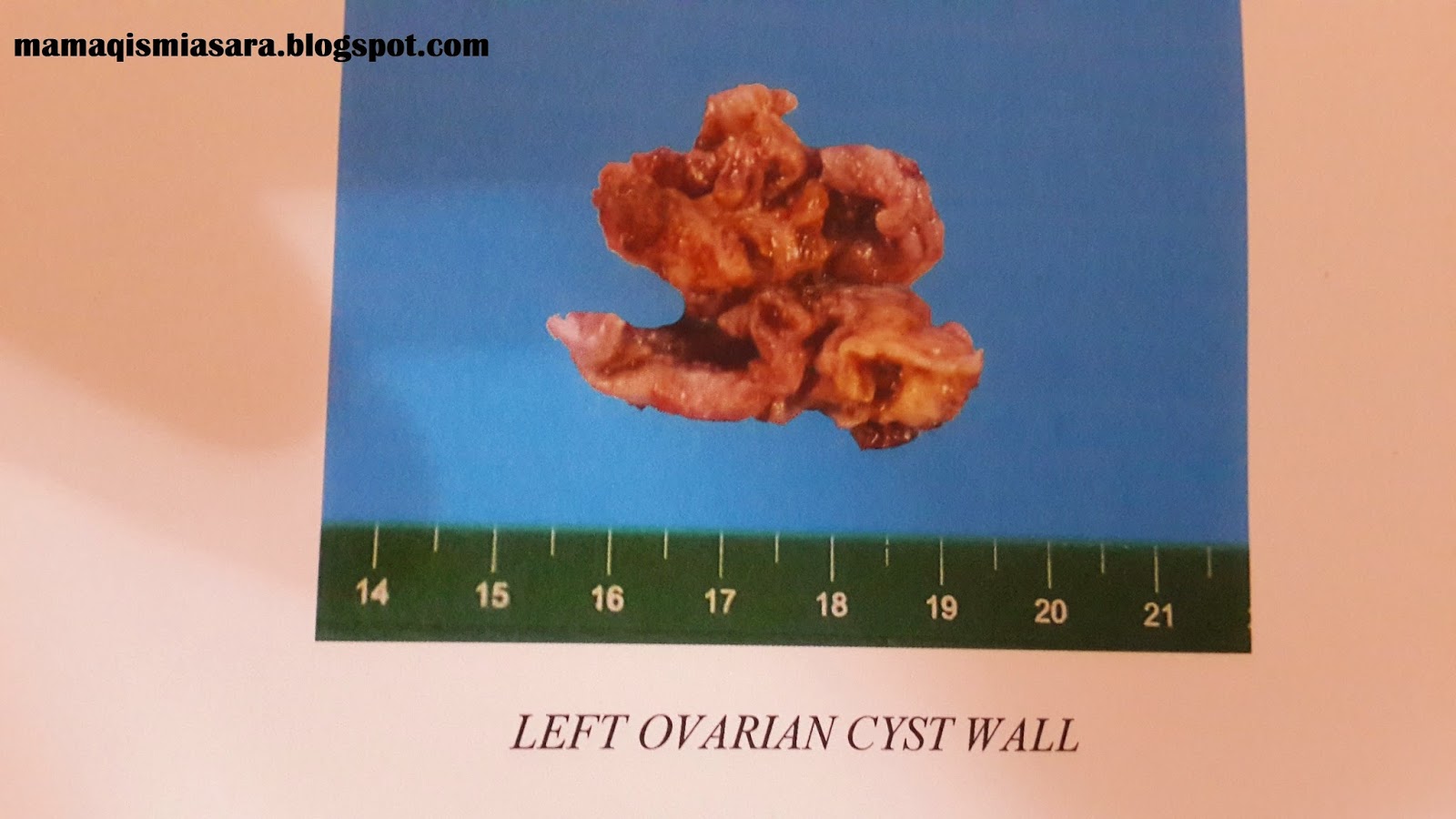 its All aBout mY sELf,mR.fAhZaL & lil qIstiNa: Gambar Cyst