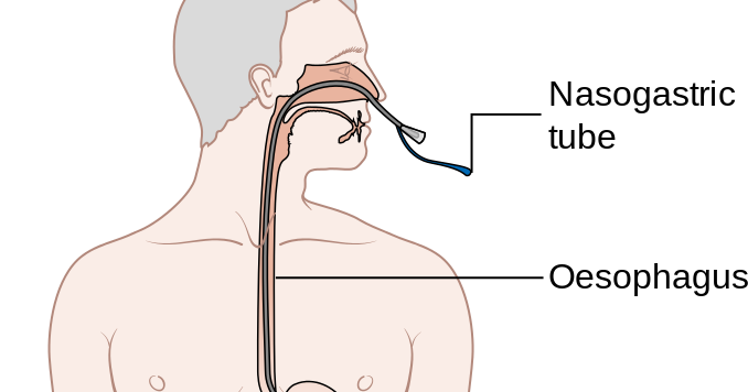 Race Sherpa Rises: Part Two: The NG Tube Blues, Awesome Nurses, the No ...