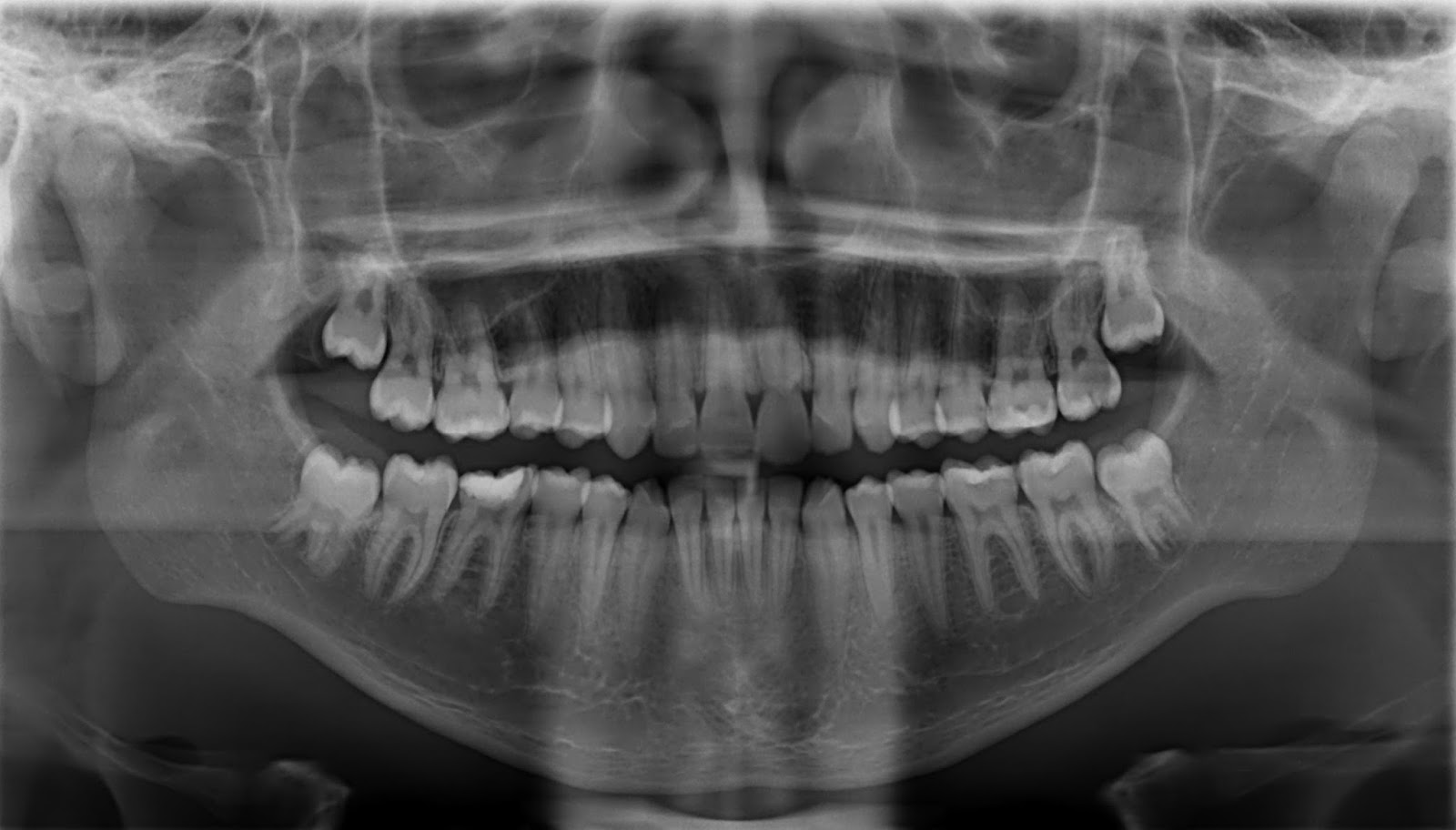 Ortodontia.com.Borel: Dentes Supranumerários.