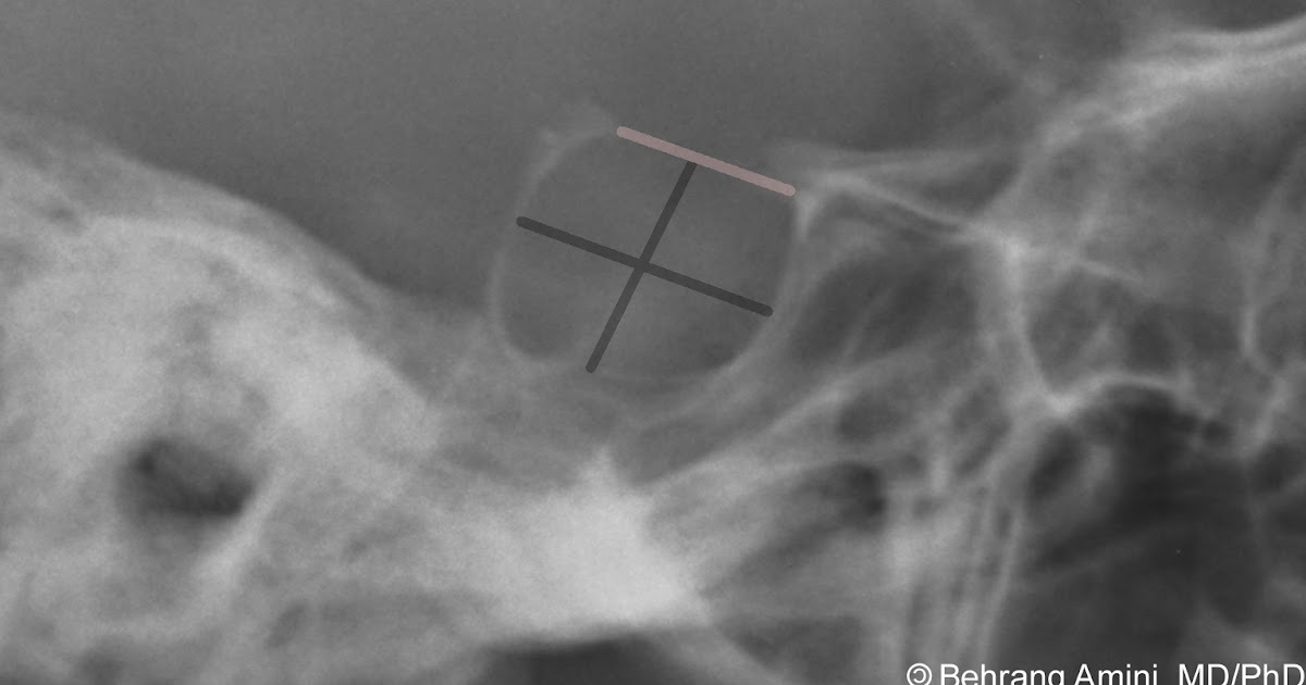 Roentgen Ray Reader: Sella Turcica Dimensions on Radiographs