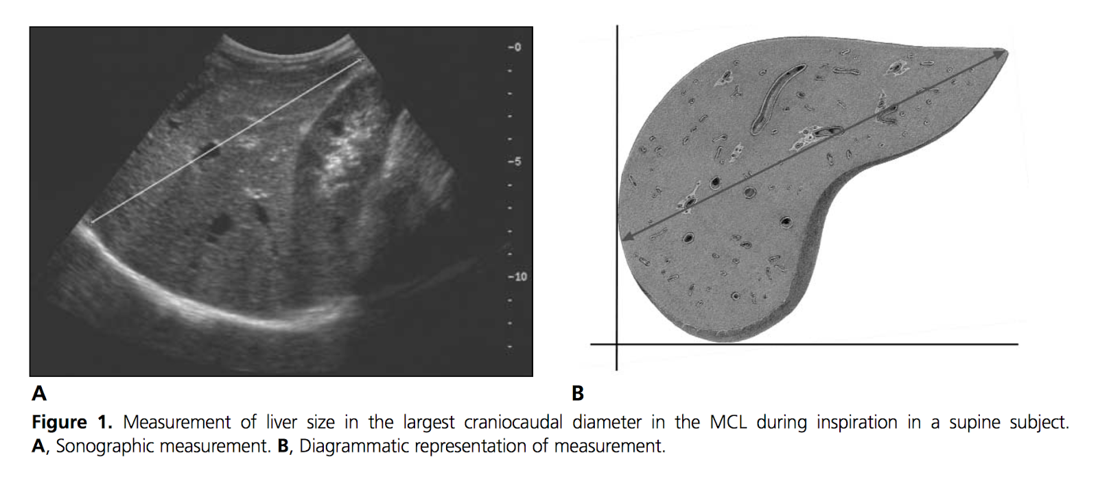 Ecografía en Atención Primaria: HEPATOMEGALIA.... ¿cómo se comprueba?