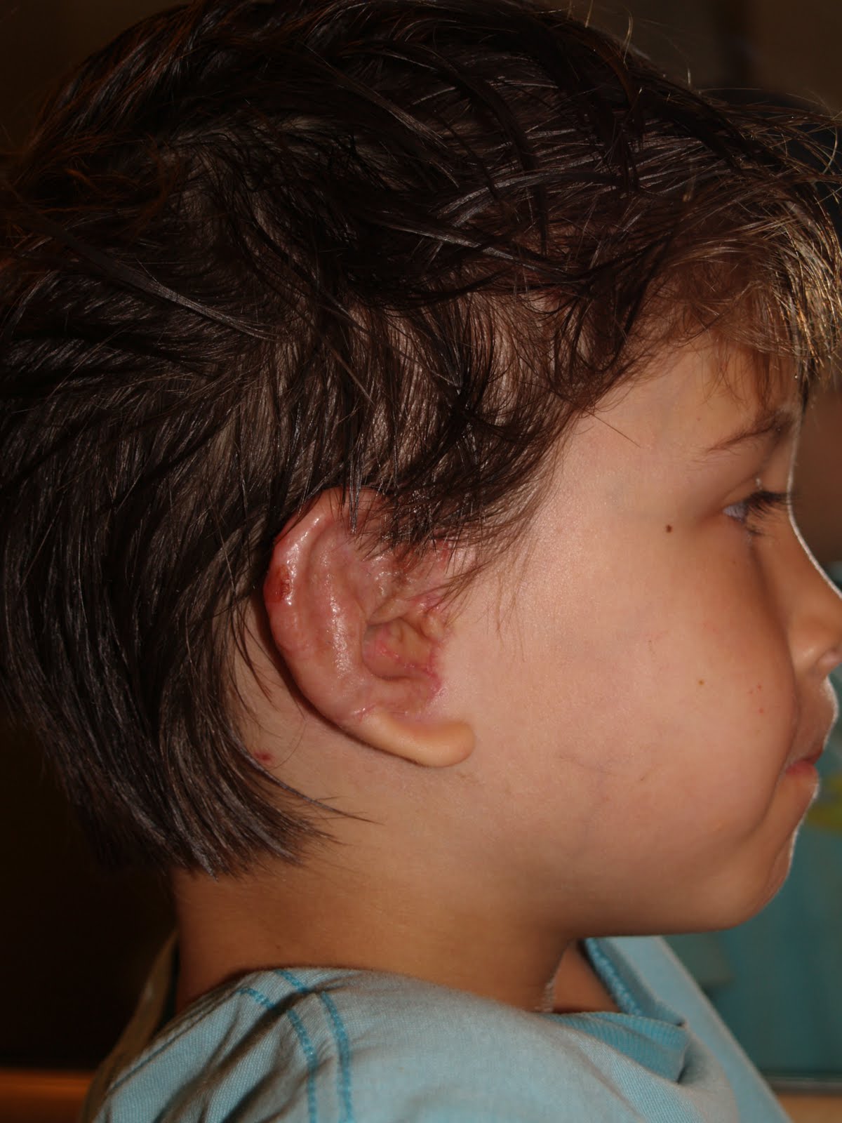 Microtia and Aural Atresia - Our Experience