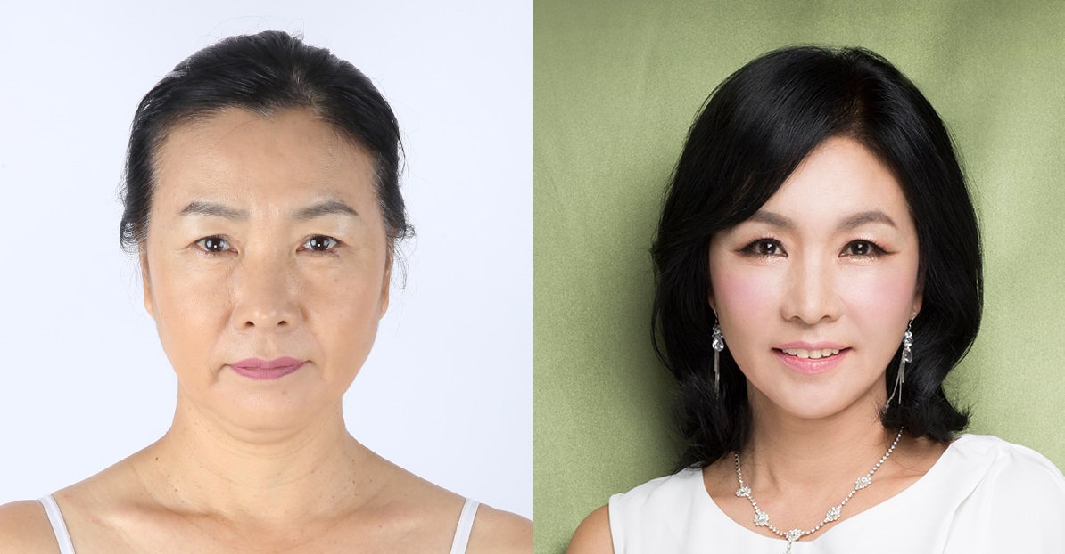 Plastic Surgery in Korea : Volume UP, face value DOWN - Fat Grafting