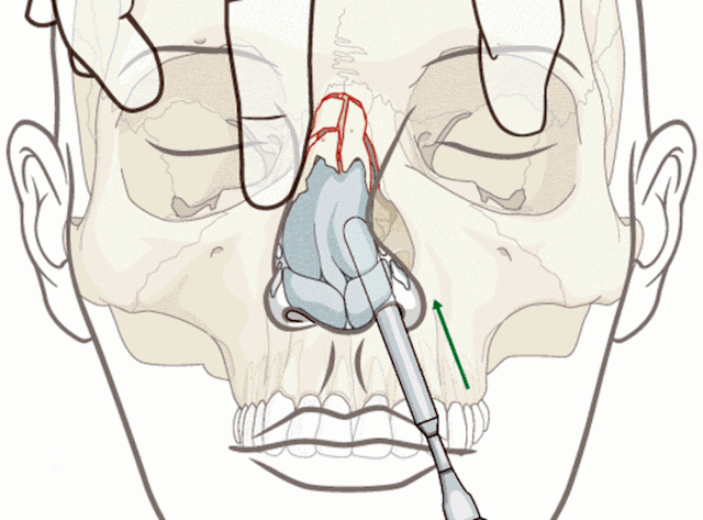 Nasal Fractures - Causes, Symptoms, Diagnosis, Treatment