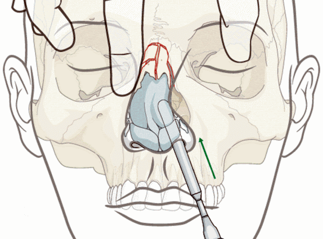 Nasal Fractures - Causes, Symptoms, Diagnosis, Treatment