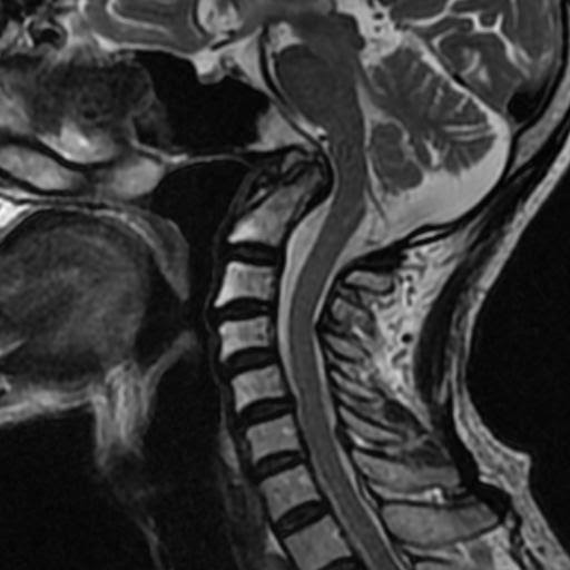 Neuroradiology Cases: Platybasia with Basilar invagination