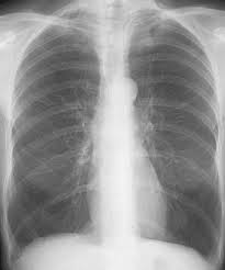 What To Do When The Nurse Calls YOU !: How to Read Chest X- Ray