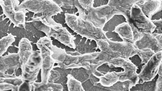 Flesh Eating Bacterial Infection Causes Symptoms And Treatment