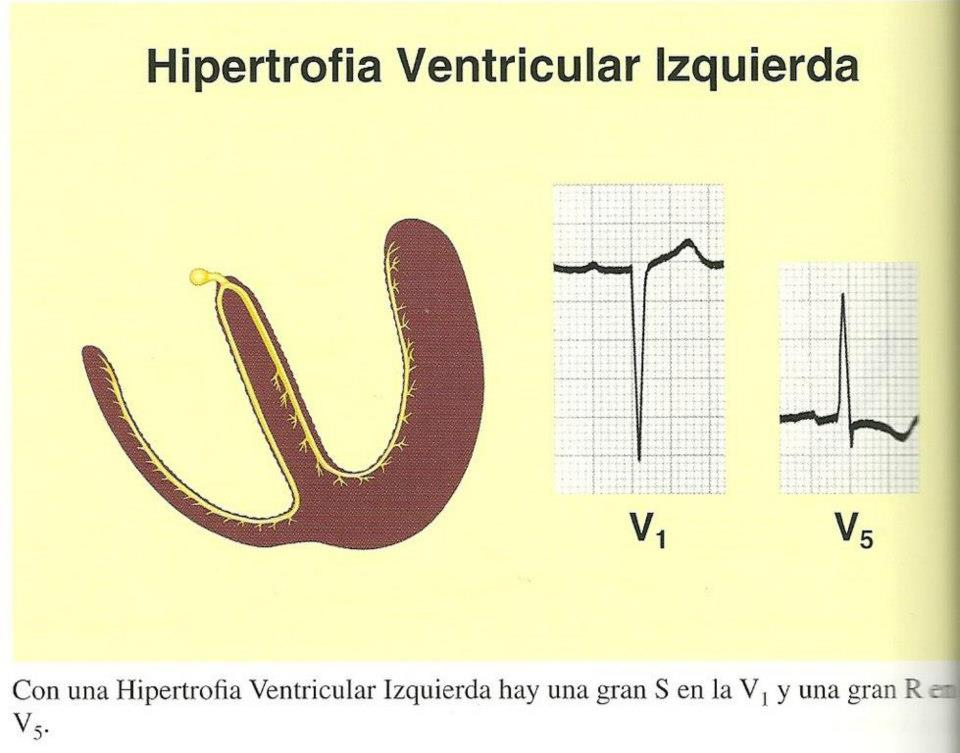 Electrocardiograma y Medicina General: Hipertrofia ventricular izquierda