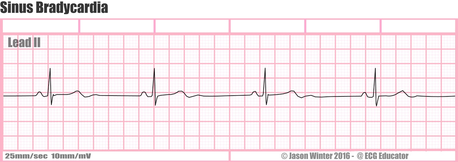 ECG Educator Blog : Six Second ECG Rhythm Strips