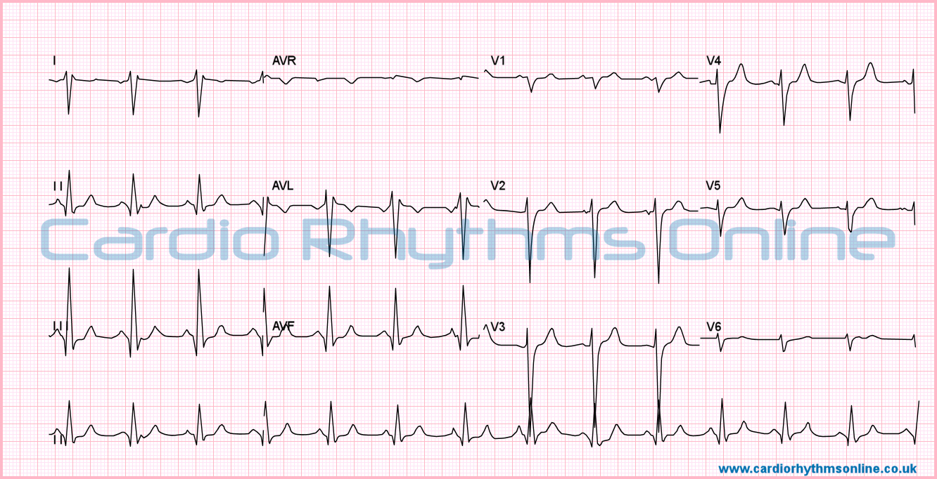 CVT Mohd Farid: ECG Basic:Cardiac Axis-Credit Cardio Rhythm Online Blogspot