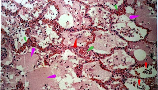 DESTINO MEDICO: MICROSCOPIO VIRTUAL PATOLOGIA PULMONAR - EDEMA PULMONAR