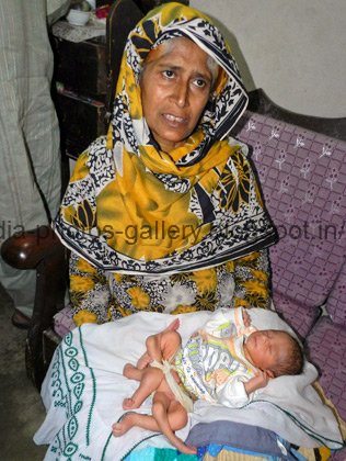 INDIA PHOTO GALLERY: Extremely rare birth defects
