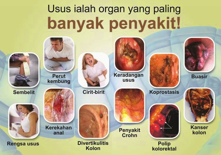 WAJIB BACA! Sembelit, kentut, perut kembung bukan pekara biasa ...