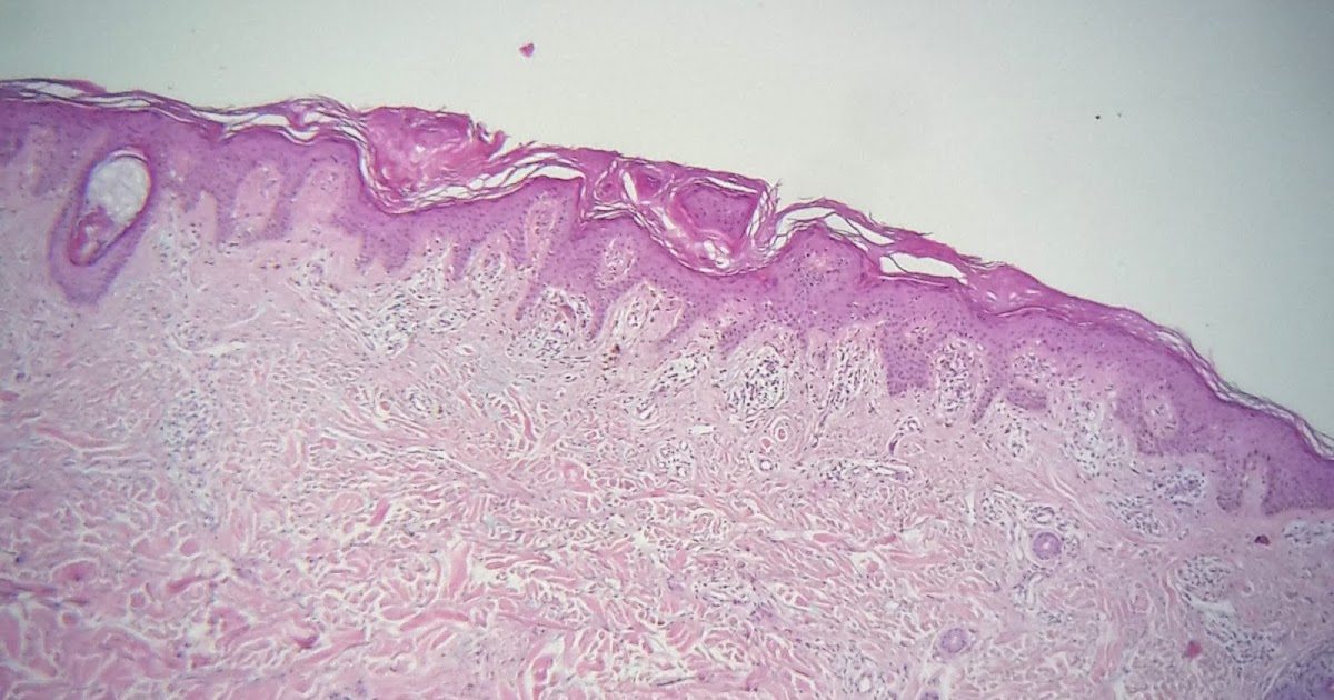 CDPath-Dermatology: Lichen/Macular amyloidosis