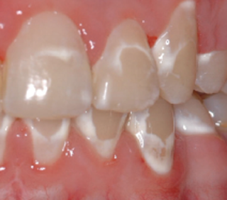 Lesiones de mancha blanca en ortodoncia