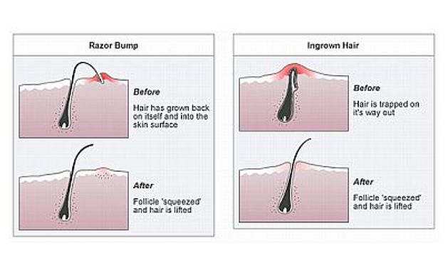 Herbal Medicine: HOW TO TREAT INGROWN HAIRS AND PREVENTION