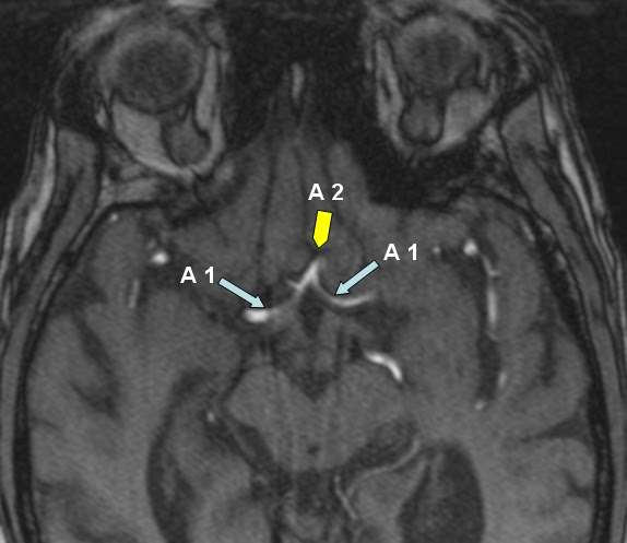 mricases: Azgos Anterior cerebral artery