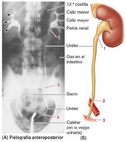 Médicosblastos Compartiendo Conocimientos : Estrechamientos de los ureteros