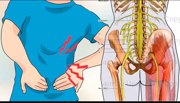 como aliviar el dolor del nervio ciático ~ Salud las 24 Horas