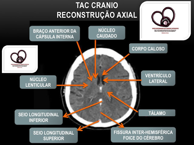 Viver Enfermagem em Cuidados Intensivos: TAC DE CRANIO... VISUALIZANDO ...